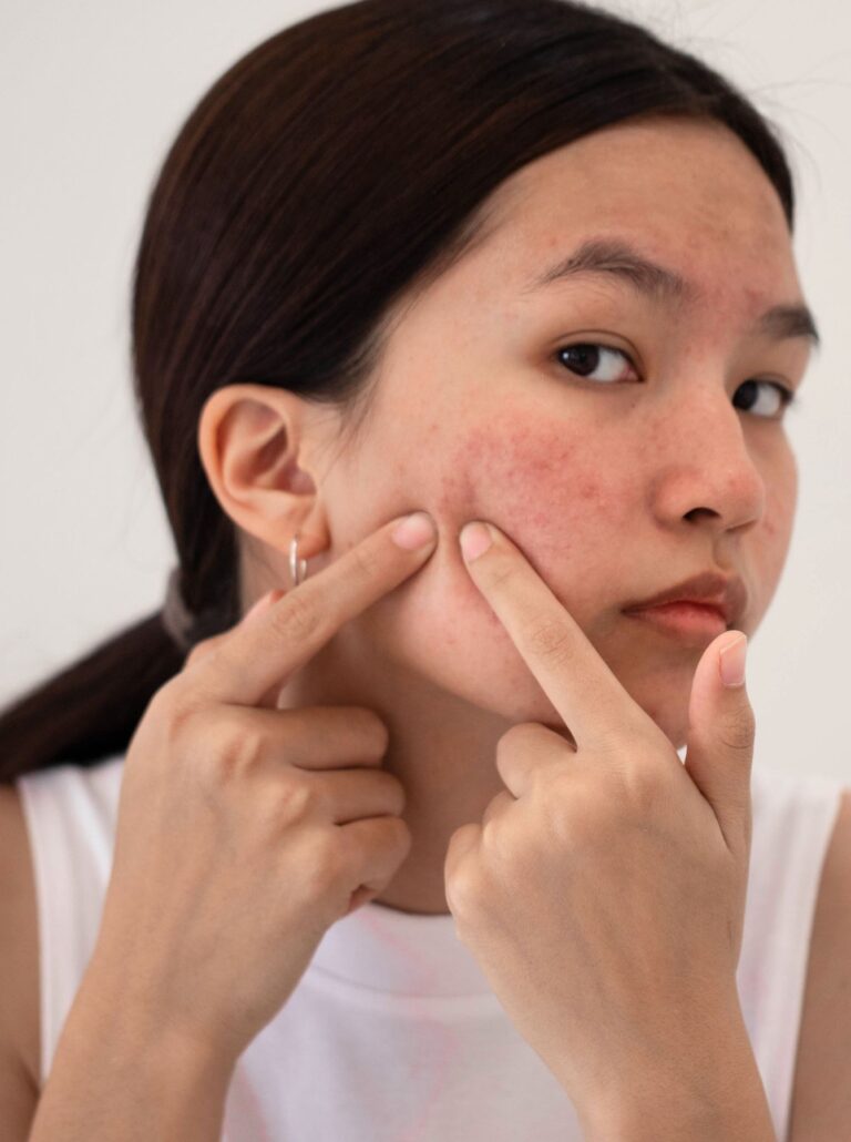 Ultimate Guide to Skin Purging (What Is It and How To Deal With It)