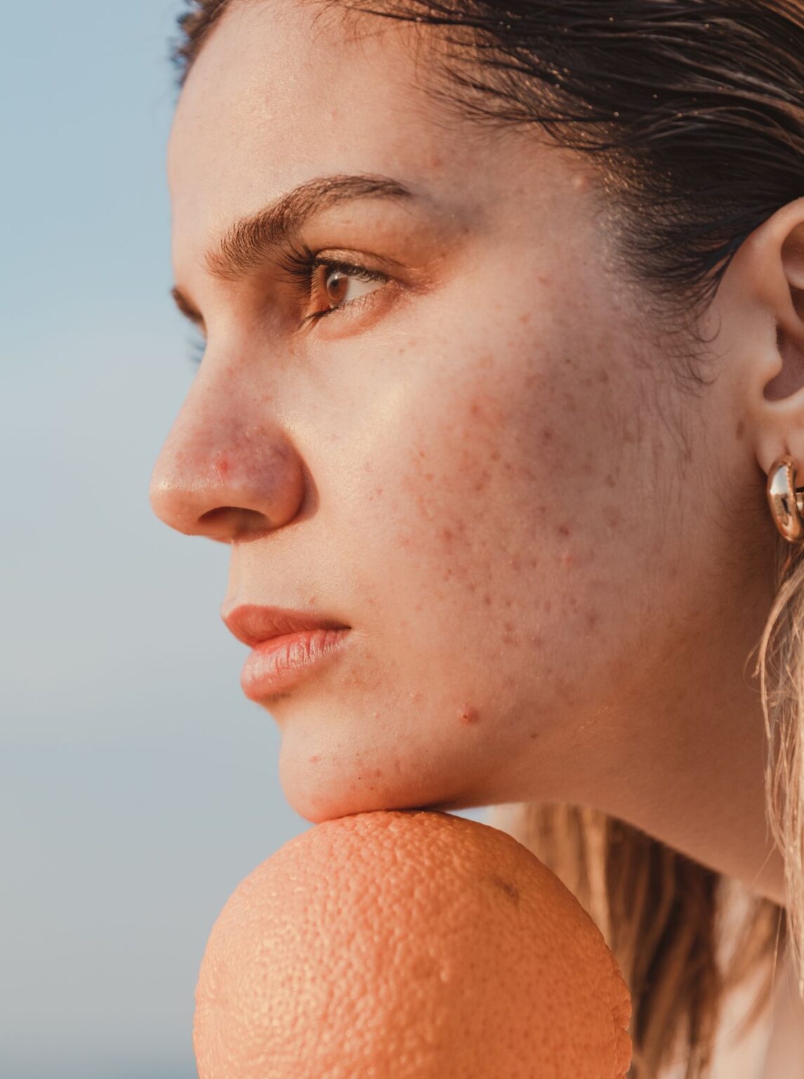 Ultimate Guide to Skin Purging (What Is It and How To Deal With It)