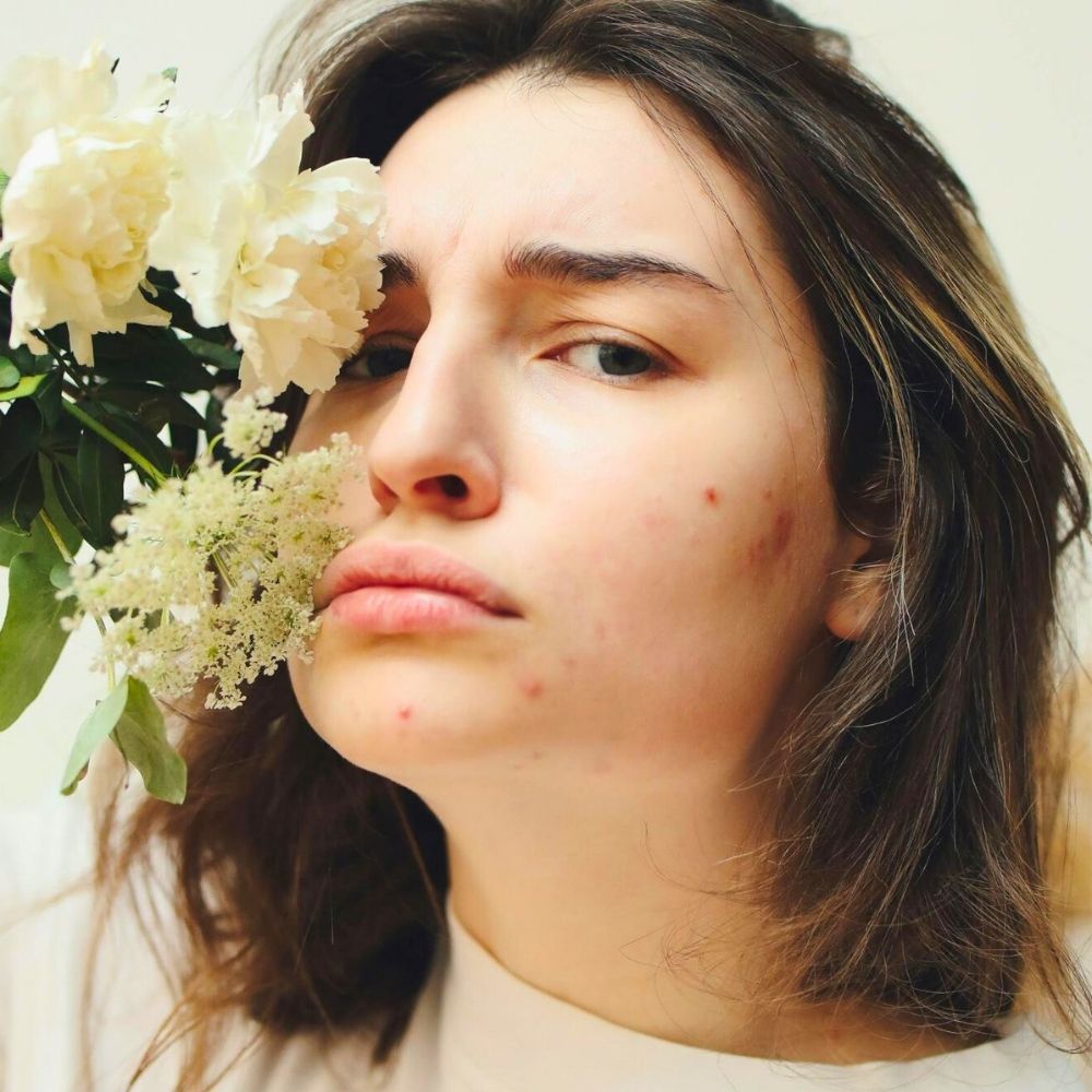 Not Sure Why You're Breaking Out? Here Are 12 Most Common Causes Of Acne